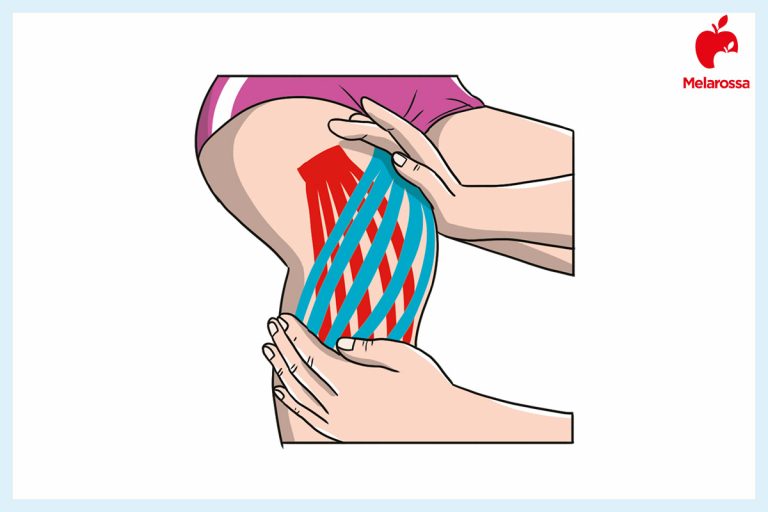 Kinesio taping: che cos'è, a cosa serve, come si usa, benefici