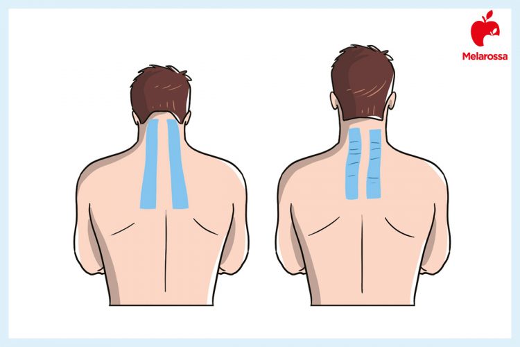 Kinesio taping: che cos'è, a cosa serve, come si usa, benefici