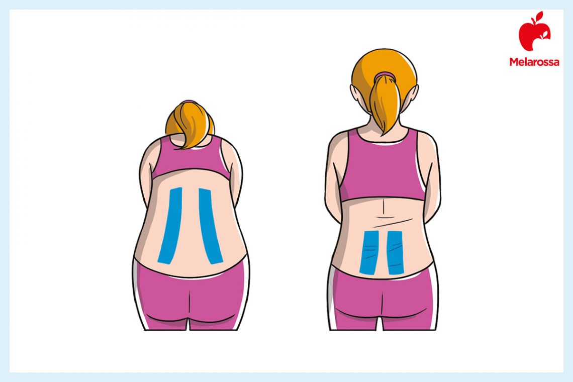 Kinesio taping: che cos'è, a cosa serve, come si usa, benefici