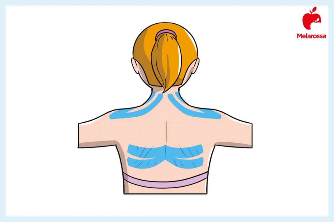 Kinesio taping: che cos'è, a cosa serve, come si usa, benefici