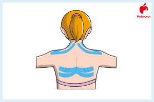 Kinesio taping: che cos'è, a cosa serve, come si usa, benefici