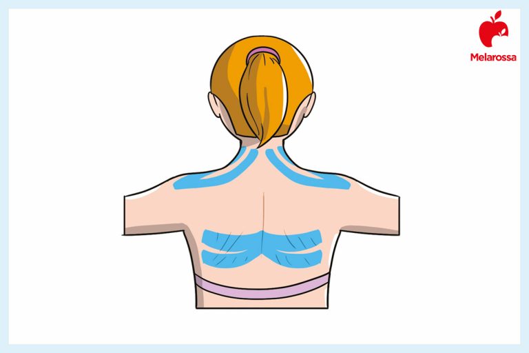 Kinesio taping: che cos'è, a cosa serve, come si usa, benefici