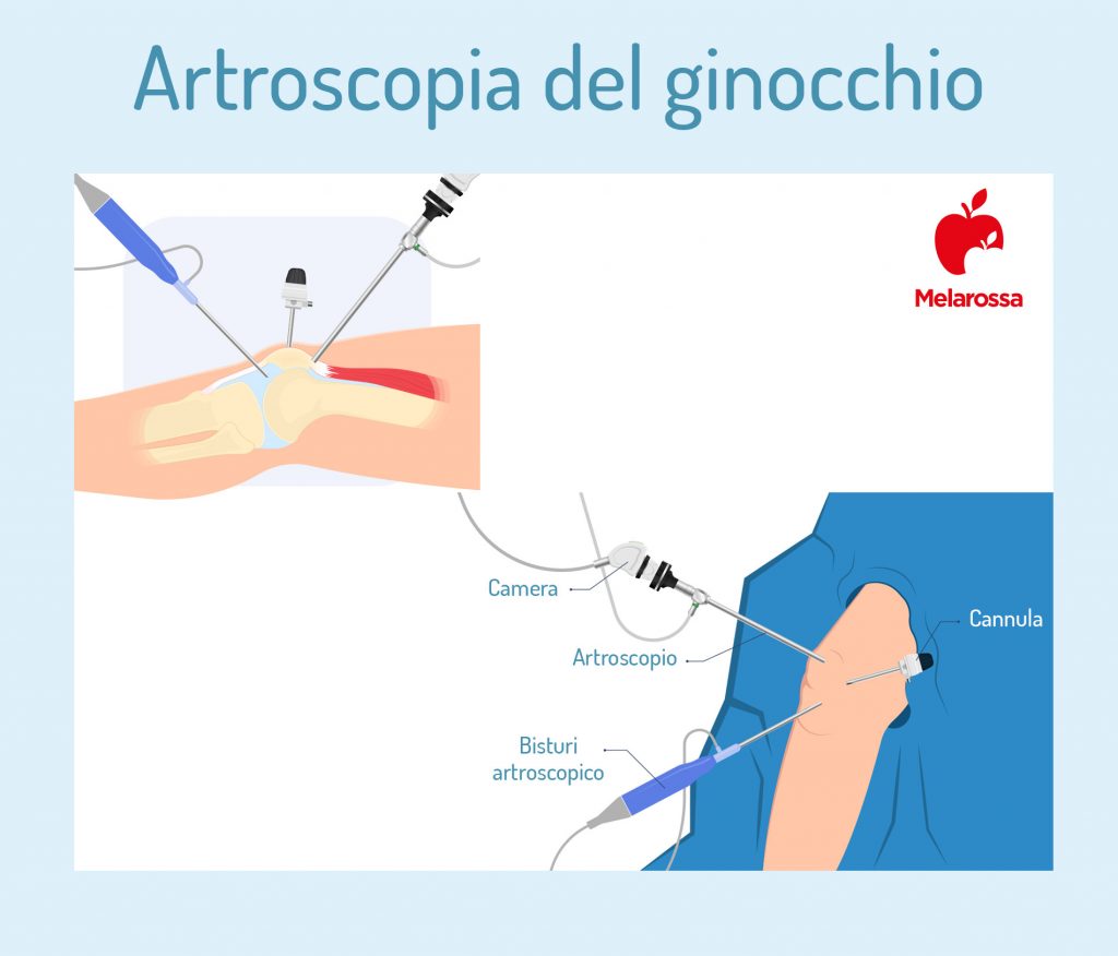 Menisco: anatomia, sintomi e cure della rottura e della lesione