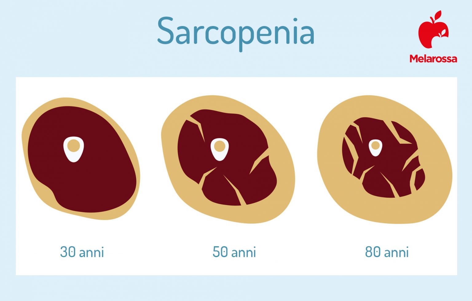 Sarcopenia: che cos'è, cause, sintomi, cure e come prevenirla