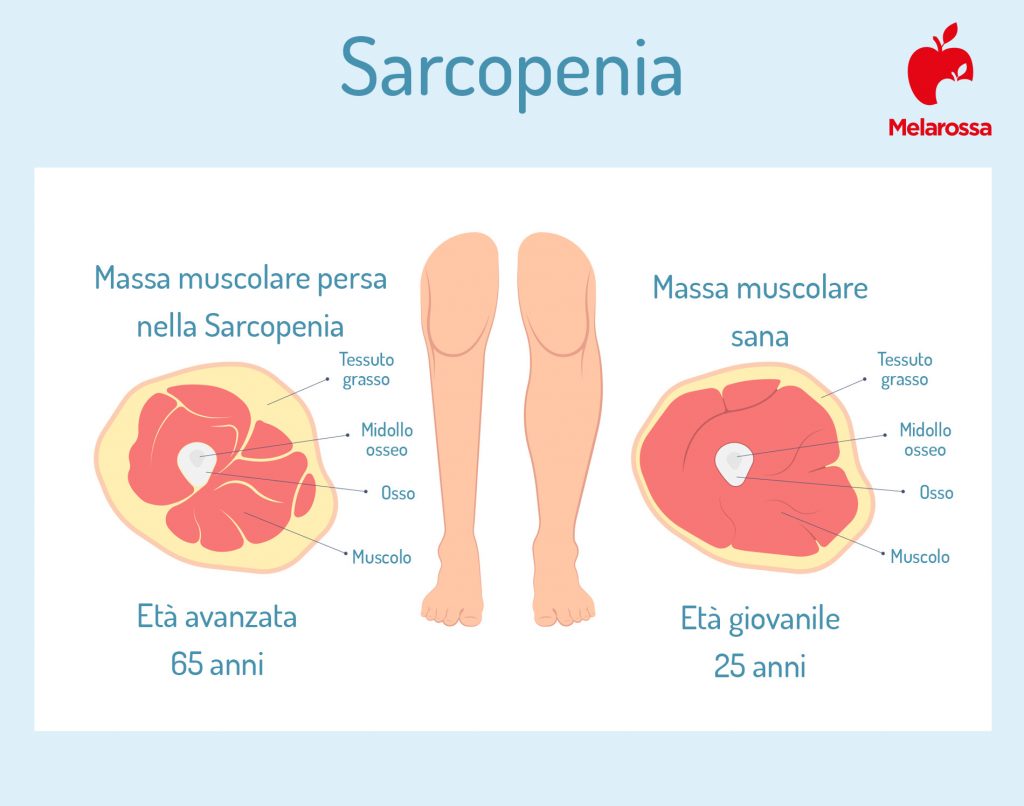 Sarcopenia: cos'è, sintomi, cure e come prevenirla