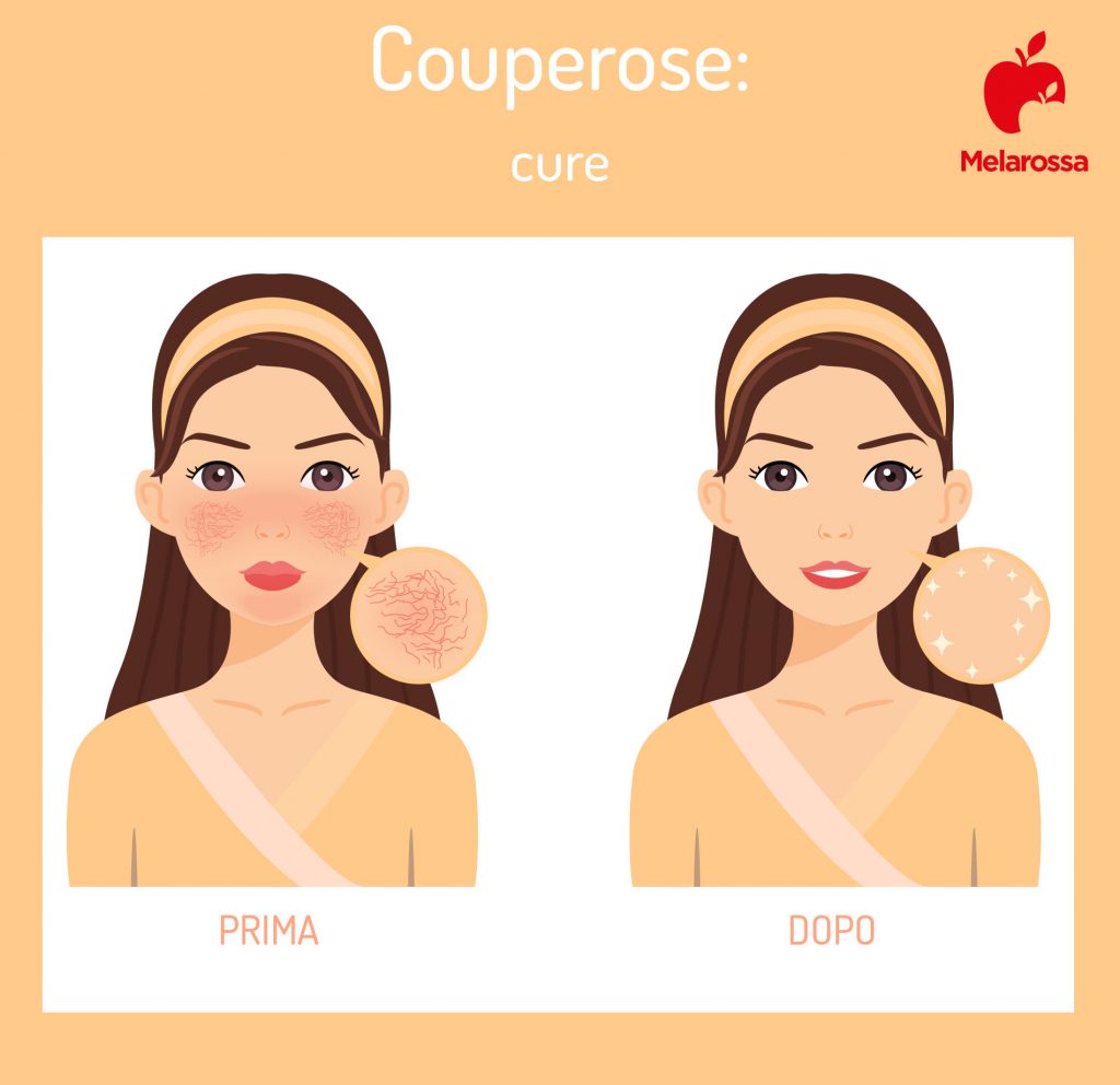 Couperose: che cos'è, cause e sintomi, cure, come prevenire
