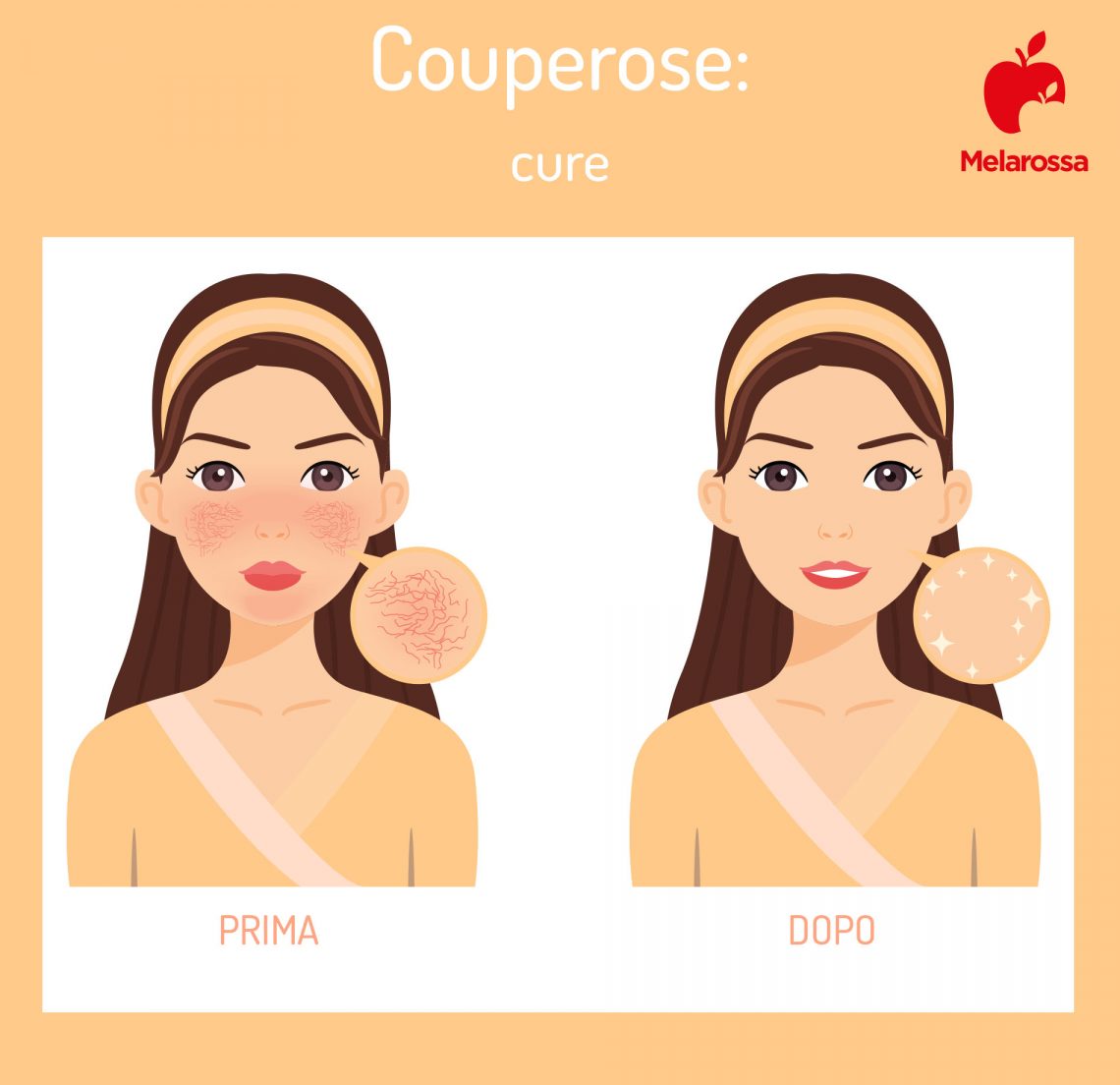Couperose: che cos'è, cause e sintomi, cure, come prevenire