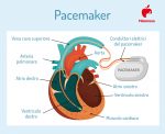 Pacemaker: che cos'è, come funziona, come si impianta, benefici