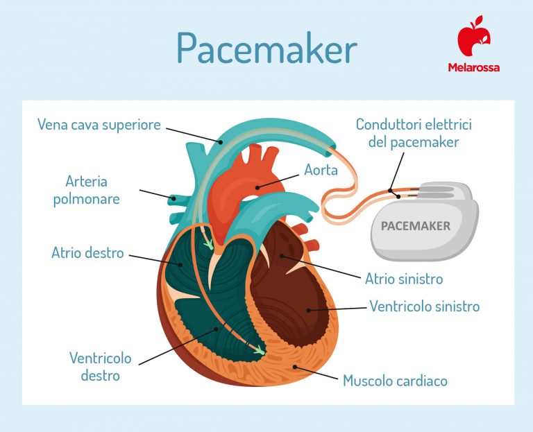 Pacemaker: che cos'è, come funziona, come si impianta, benefici
