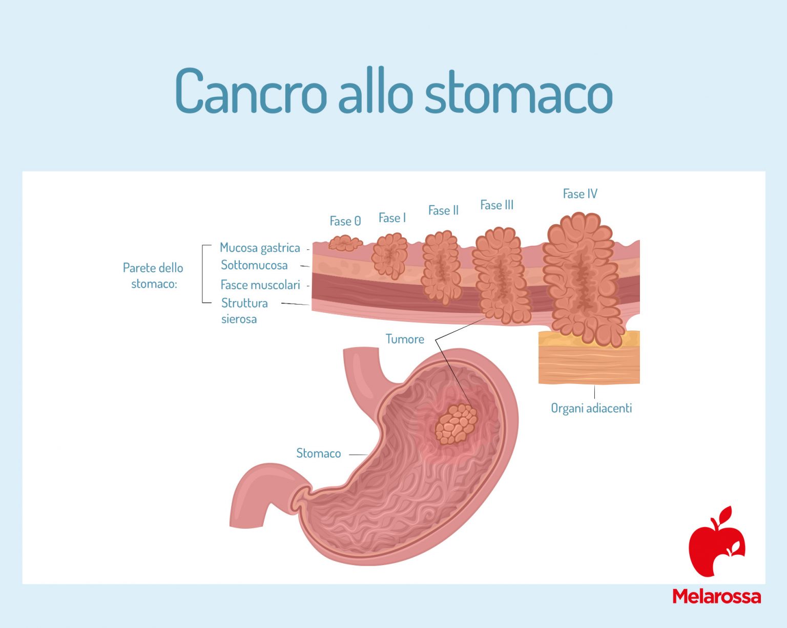 Tumore allo stomaco: che cos'è, cause, sintomi, diagnosi, cure