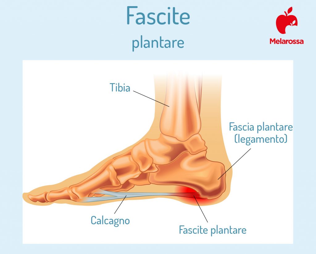 Fascite plantare: che cos'è, sintomi, cause, diagnosi e cure