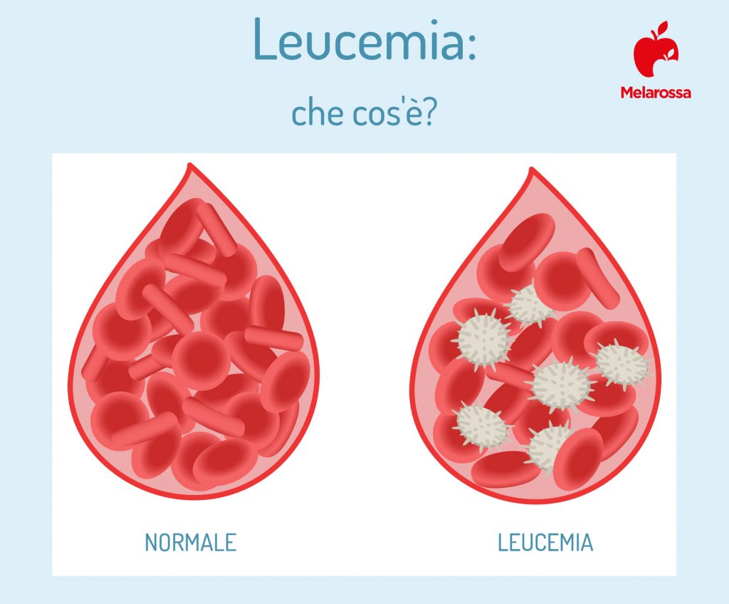 Leucemia: che cos'è, sintomi, cause, diagnosi e cure
