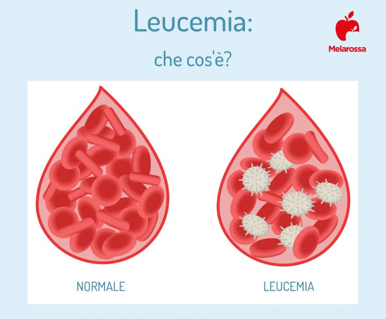 Leucemia: che cos'è, sintomi, cause, diagnosi e cure