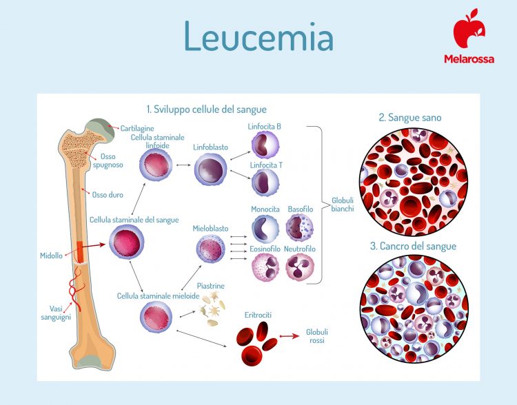 Leucemia: che cos'è, sintomi, cause, diagnosi e cure