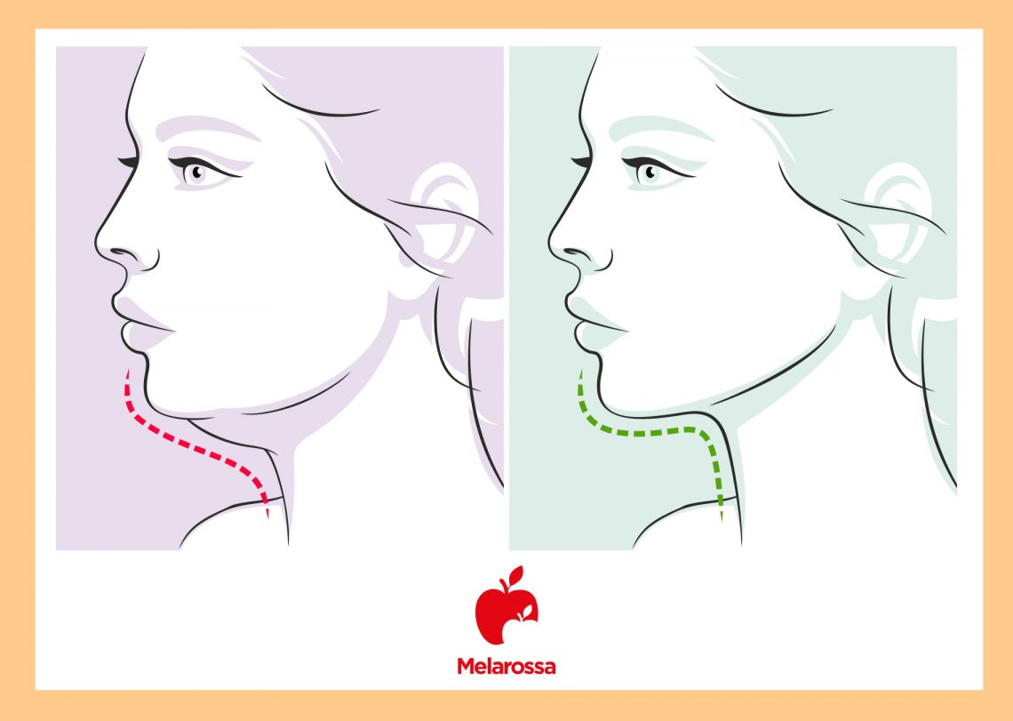 Doppio mento: cause, rimedi e come si elimina