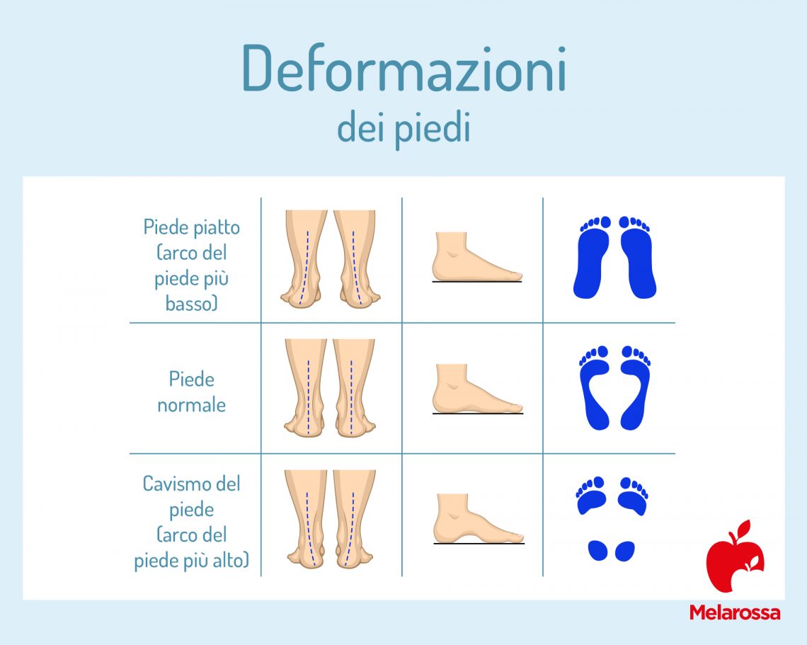Piede piatto: sintomi, cause, diagnosi, cure e prevenzione