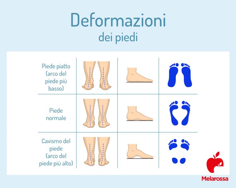 Piede piatto: sintomi, cause, diagnosi, cure e prevenzione