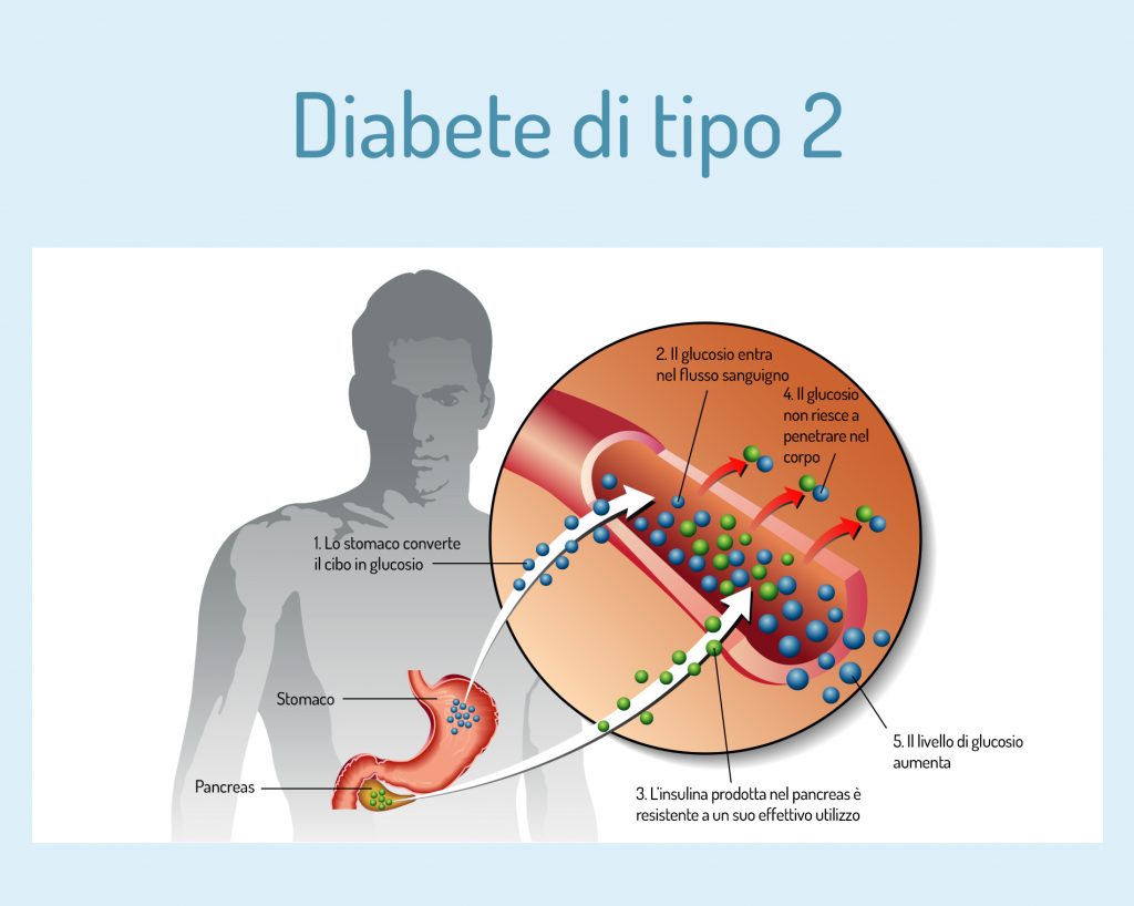 Diabete di tipo 2: che cos'è, sintomi, cause, diagnosi e cure