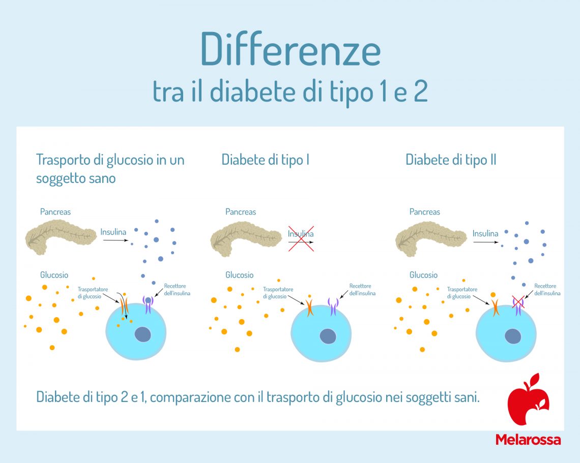 Diabete di tipo 1: che cos'è, cause, sintomi, diagnosi e cure