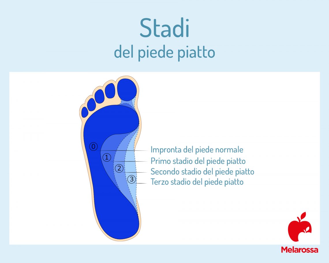 Piede piatto: sintomi, cause, diagnosi, cure e prevenzione