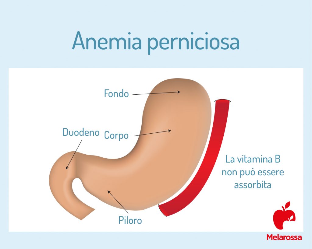 Anemia perniciosa: che cos'è, sintomi, diagnosi, cause e cura