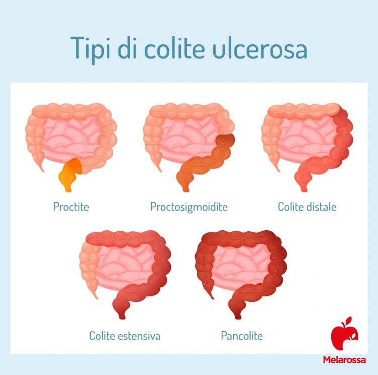 Colite ulcerosa: che cos'è, sintomi, cause, cure e cosa mangiare