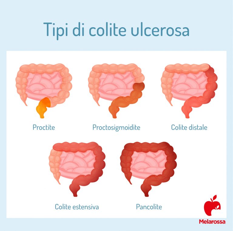 Colite ulcerosa: che cos'è, sintomi, cause, cure e cosa mangiare