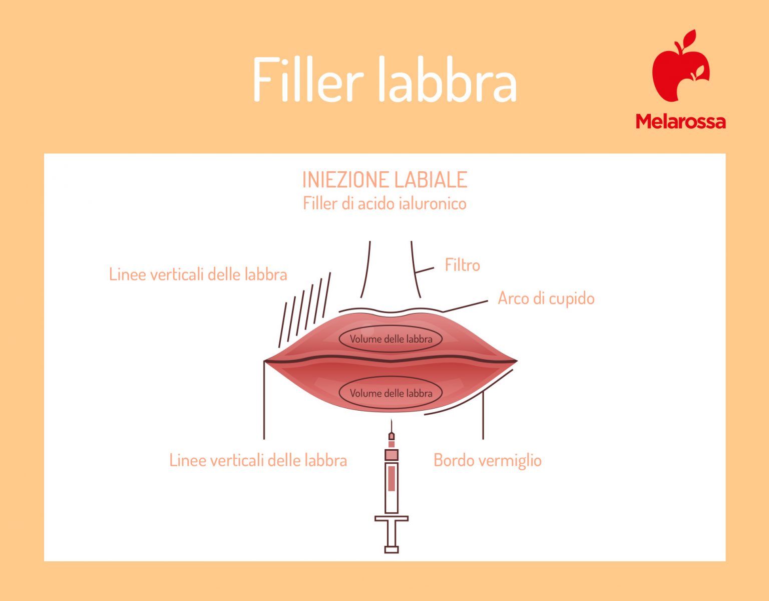 Filler: che cos'è, come funziona, costi, benefici, risultati