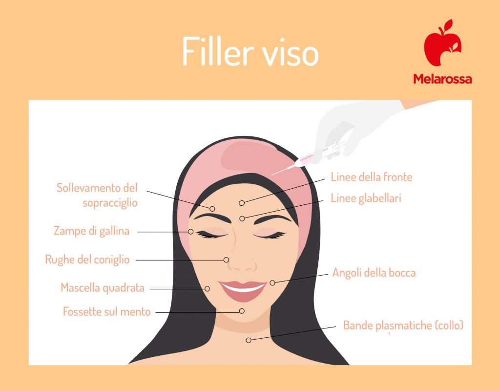 Filler: che cos'è, come funziona, costi, benefici, risultati