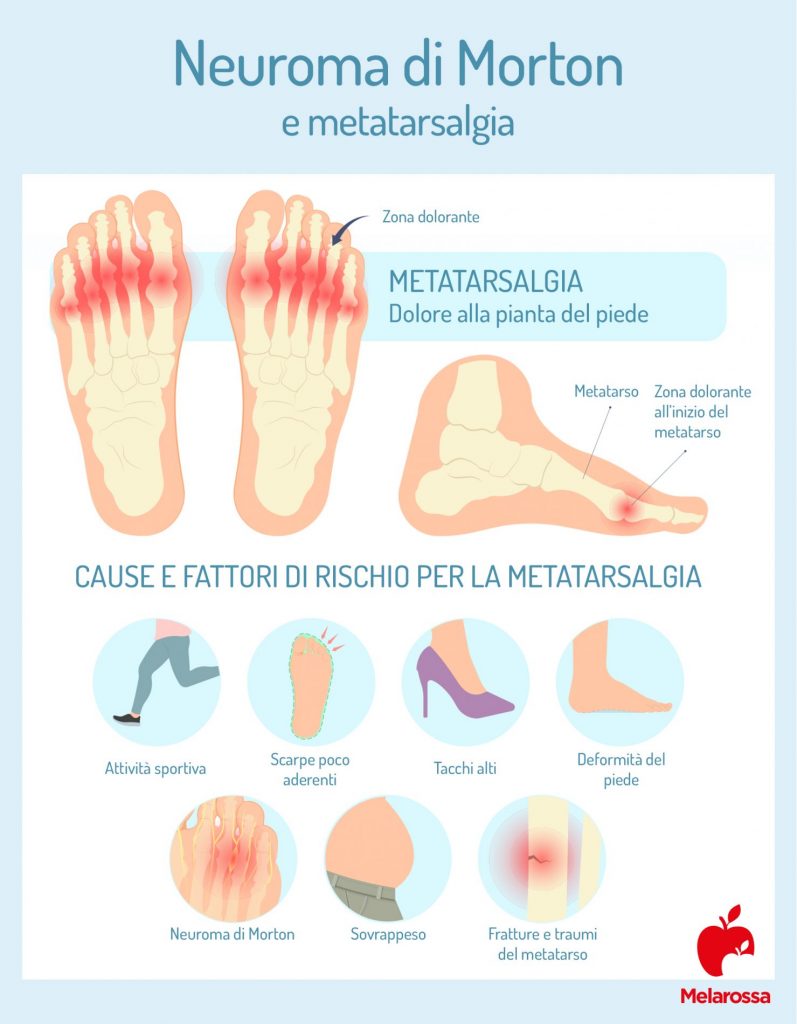Neuroma di Morton: che cos'è, sintomi e cause, come si cura