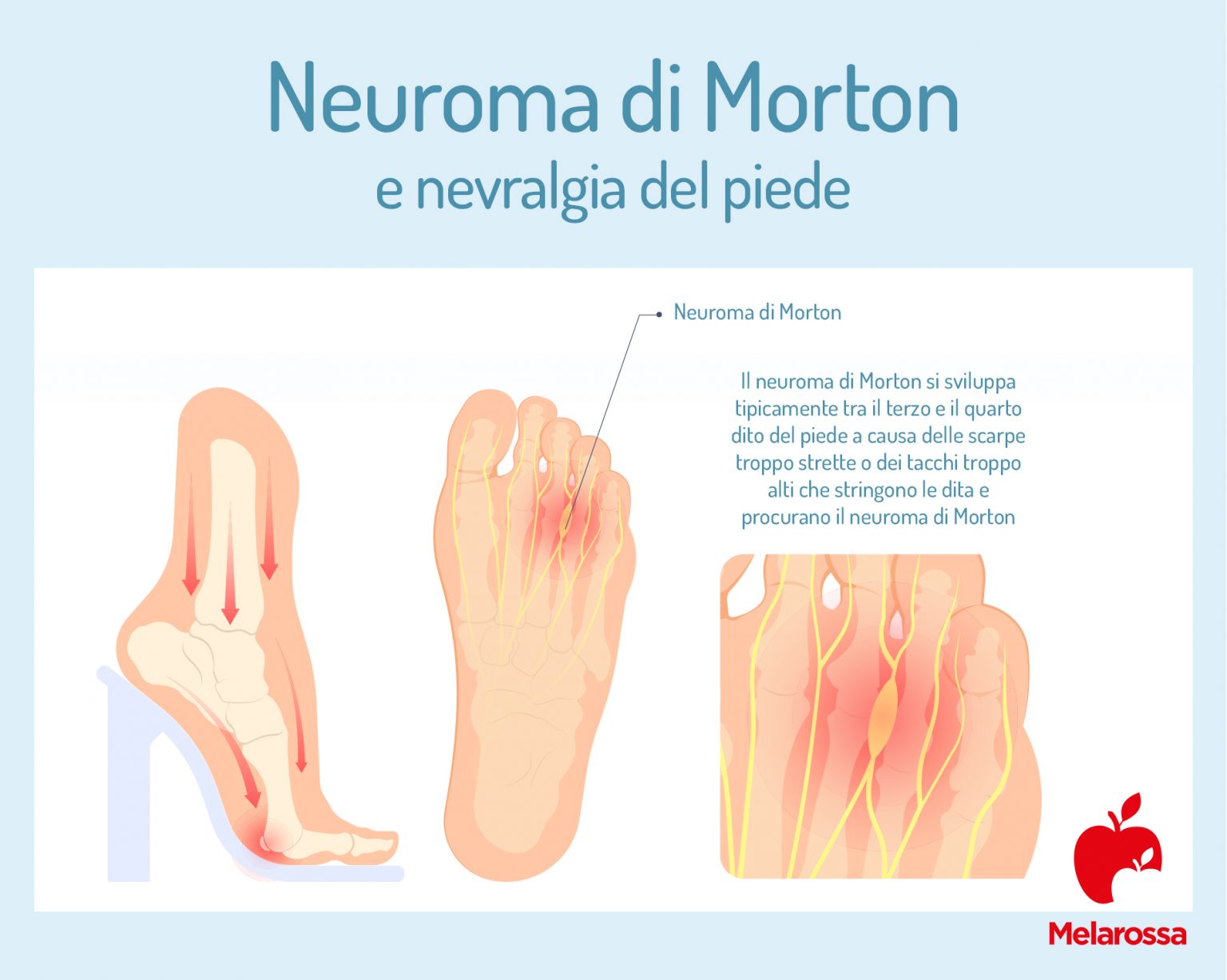Neuroma di Morton: che cos'è, sintomi e cause, come si cura