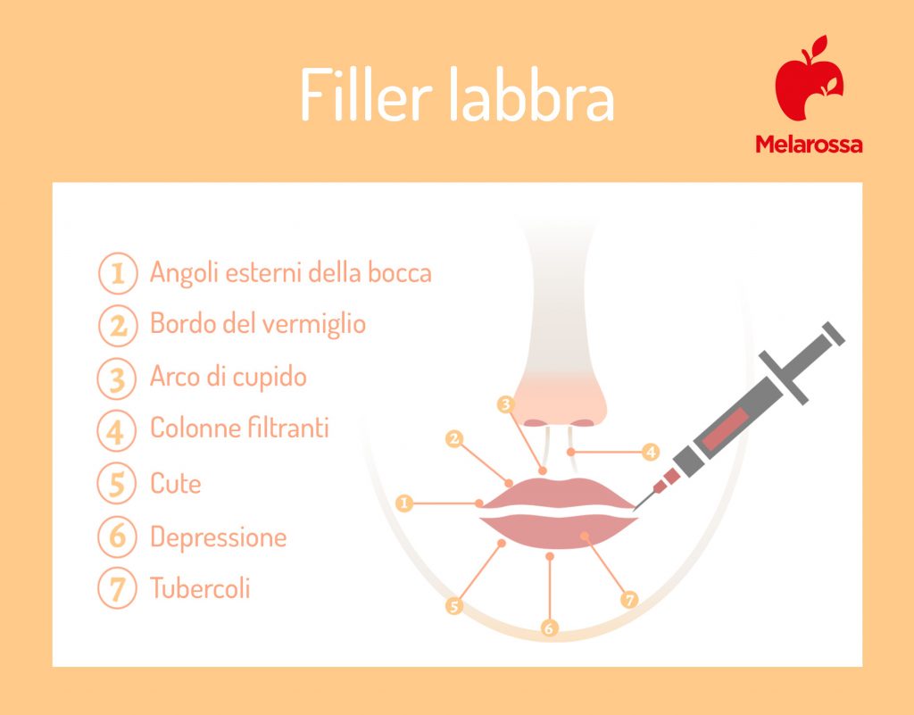 Filler labbra: che cos'è, come funziona, quanto costa, risultati