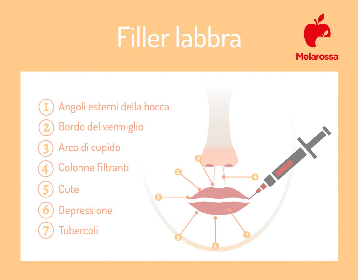 Filler labbra: che cos'è, come funziona, quanto costa, risultati