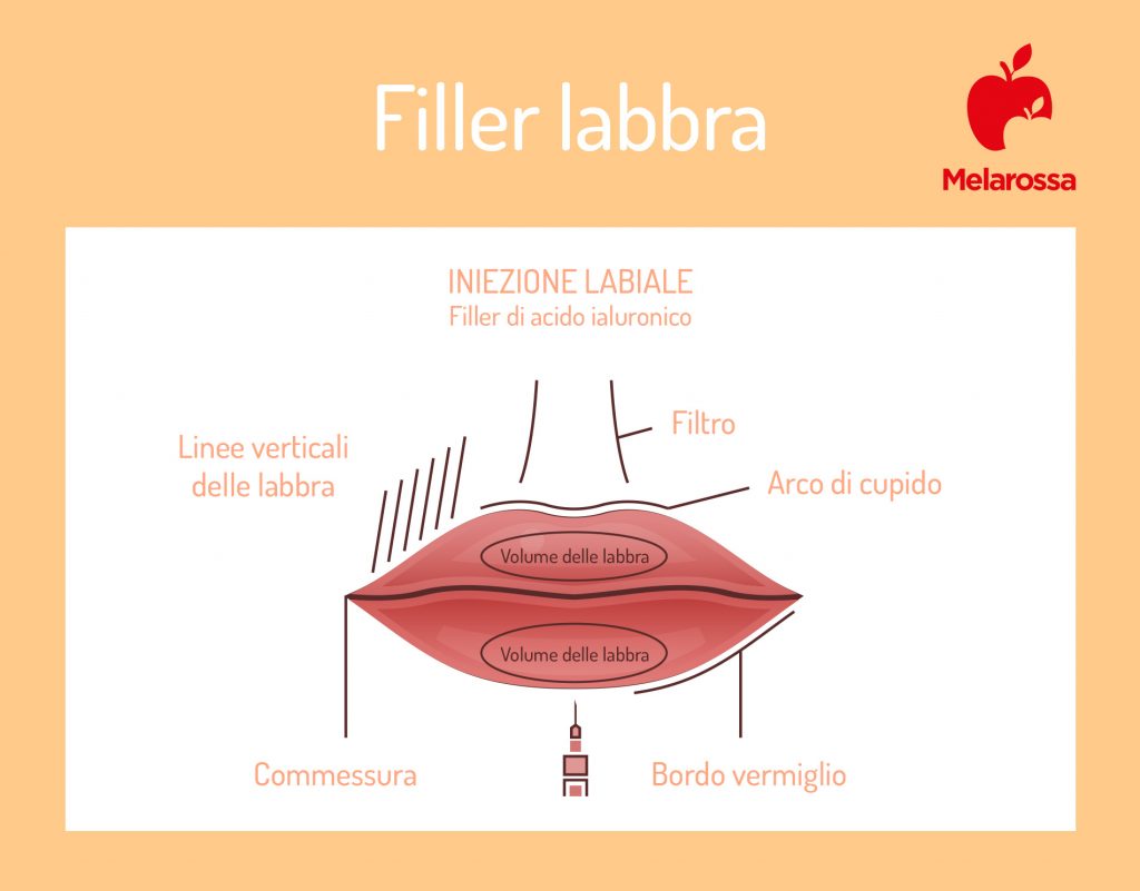 Filler labbra: che cos'è, come funziona, quanto costa, risultati