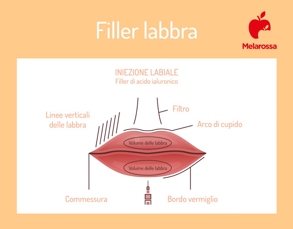 Filler labbra: che cos'è, come funziona, quanto costa, risultati