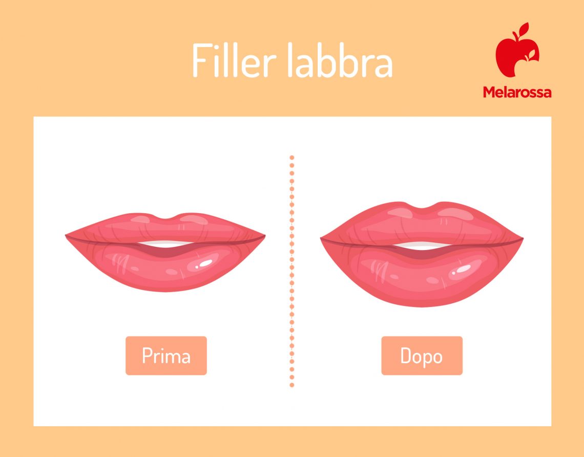 Filler labbra: che cos'è, come funziona, quanto costa, risultati