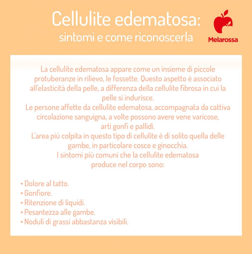 Cellulite edematosa: che cos'è, cause, come eliminarla