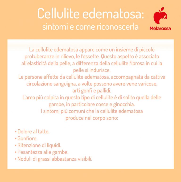 Cellulite edematosa: che cos'è, cause, come eliminarla