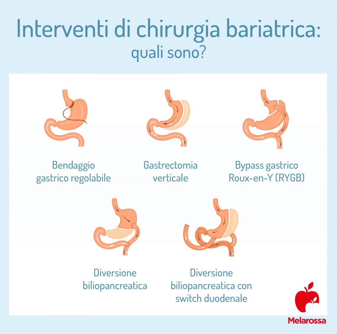 Chirurgia bariatrica: che cos'è, a cosa serve, tipologie di intervento