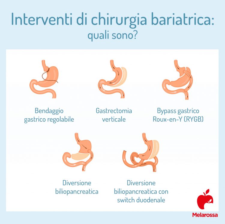 Chirurgia bariatrica: che cos'è, a cosa serve, tipologie di intervento