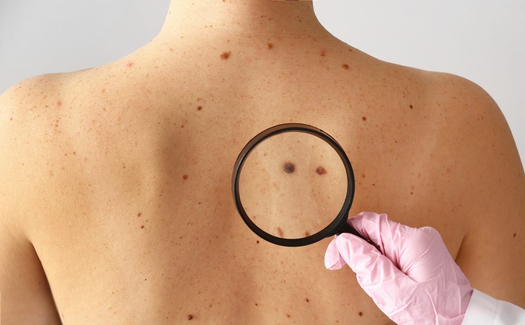 Nei: cosa sono, perché si formano, come riconoscere quelli maligni