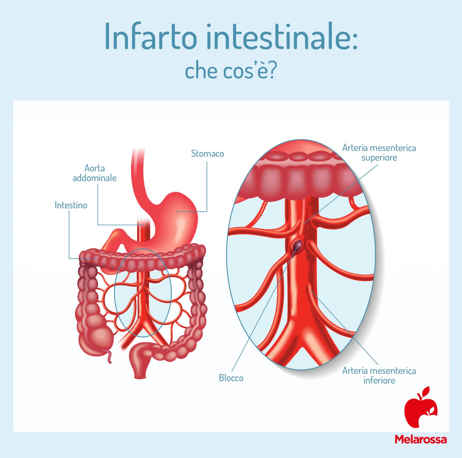Infarto intestinale: che cos'è, cause e sintomi, cure