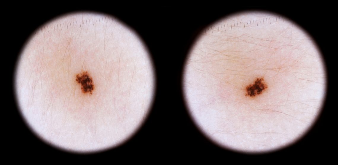 Nei: cosa sono, perché si formano, come riconoscere quelli maligni