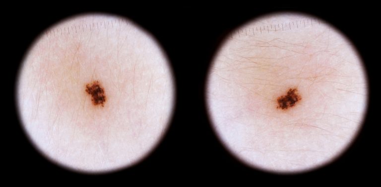 Nei: cosa sono, perché si formano, come riconoscere quelli maligni